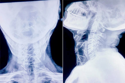 Rajasthan man with 75 pins inside his body in Mumbai for relief ...